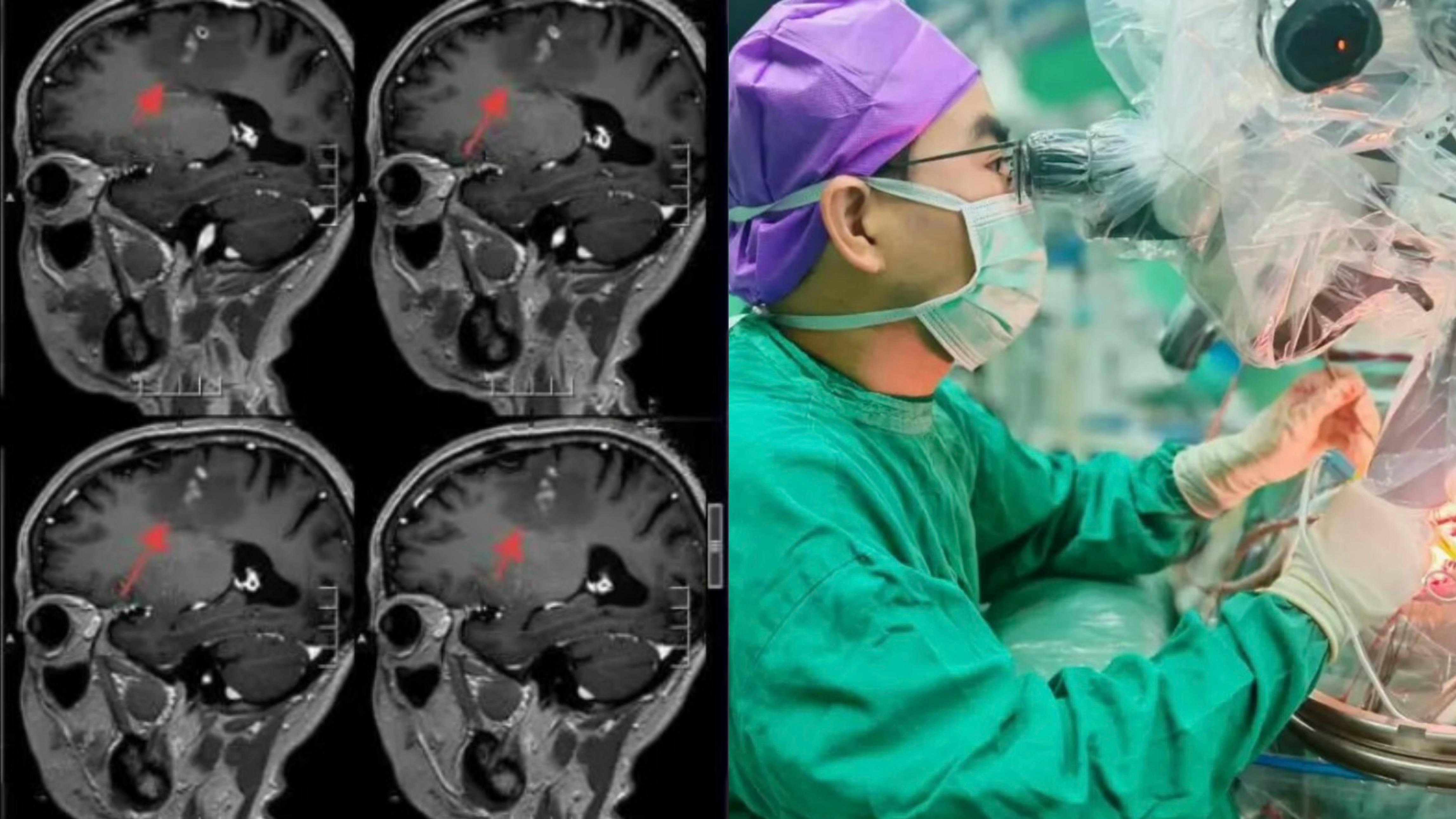 Guangdong doctors remove 10cm parasitic worm from man's brain, ending ...
